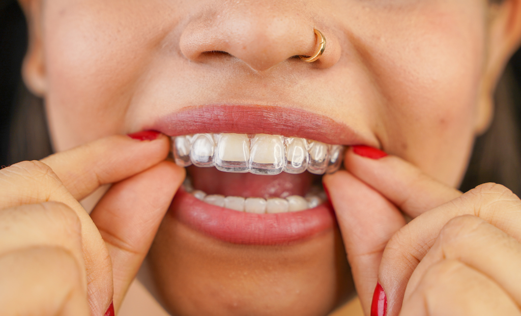 Invisalign | Cosmo Dental Clinic